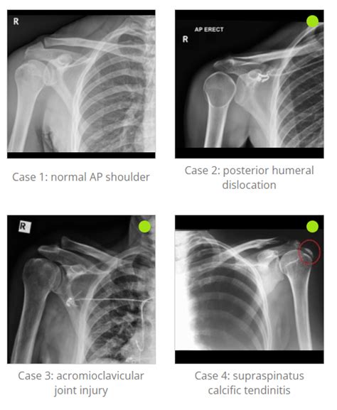 The Shoulder Ap View In Radiology An Essential Projection For Shoulder