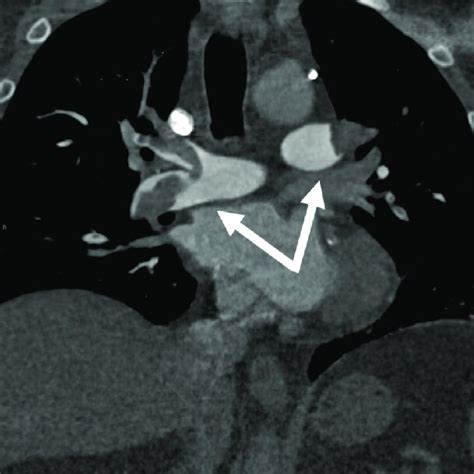 Coronal Computed Tomography Pulmonary Angiogram Revealing Filling