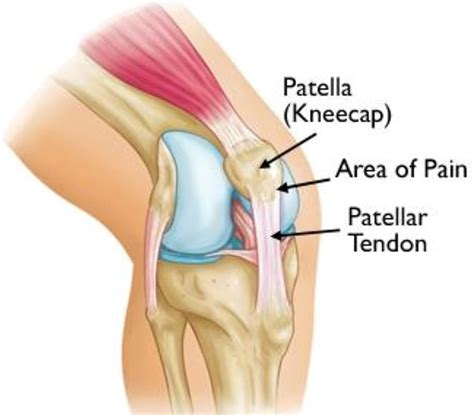 Patellar Tendinitis Causes Symptoms Stretching Exercises Treatments