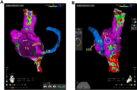 Zero Fluoroscopy Transseptal Puncture Guided By Right Atrial High Density Precision Mapping