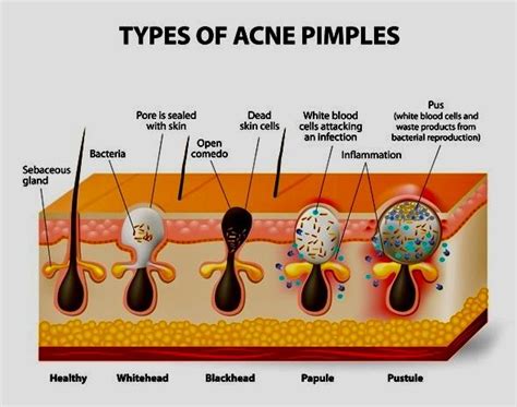 Acne Pimples Understanding The Basics Cosmetech Co In