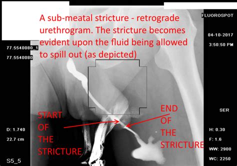 My Decision Regarding Stage One Johanson Urethroplasty For Sub Meatal
