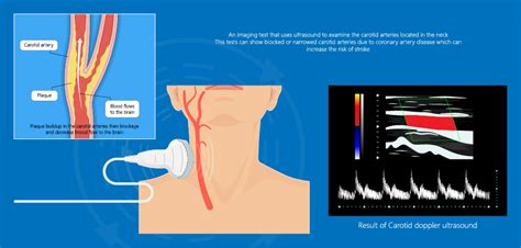 Carotid Doppler Ultrasound