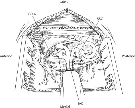 Temporal Bone Resection Ento Key