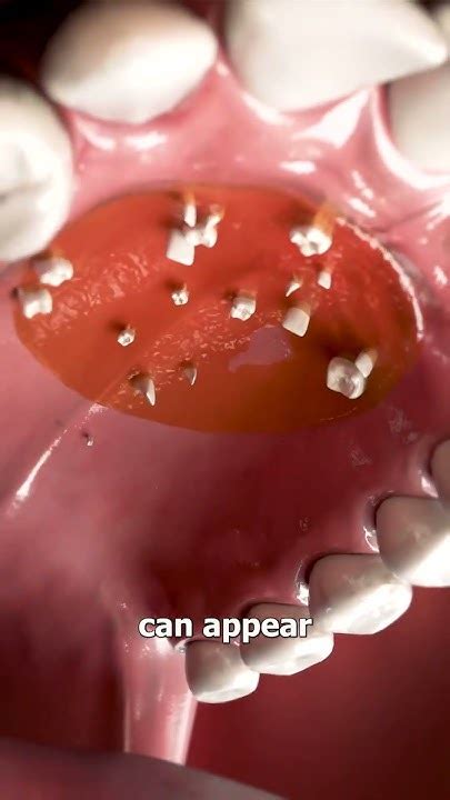 Hyperdontia Extra Teeth In The Roof Of Your Mouth Learn About This