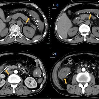Abdominal CT And Enhanced CT Revealed Extensive Calcification Of The Download Scientific