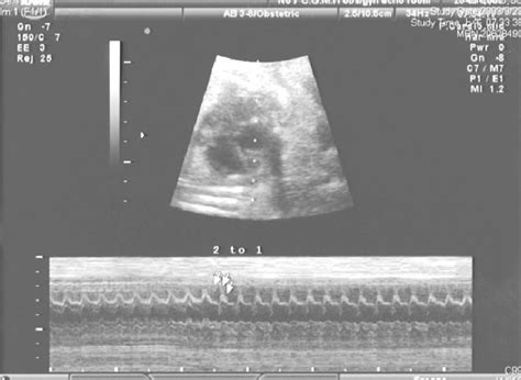 The Atrial Rate Is Faster Than The Ventricular Rate With 2 1 Download Scientific Diagram