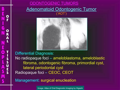 5 Odontogenic Tumor 1 Ppt