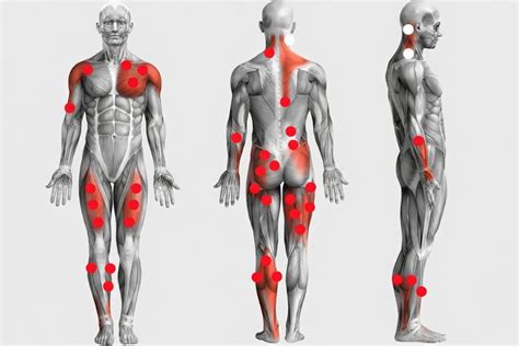 Muscle Knots Myofascial Trigger Points Causes Symptoms And Treatment