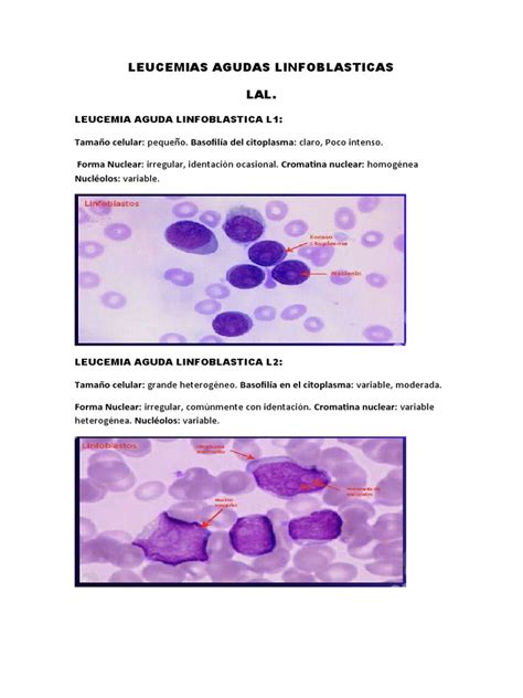 Leucemias Agudas Linfoblasticas Pdf Leucemia Sangre