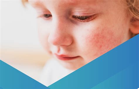 National Eczema Strategy Eczema Support Australia