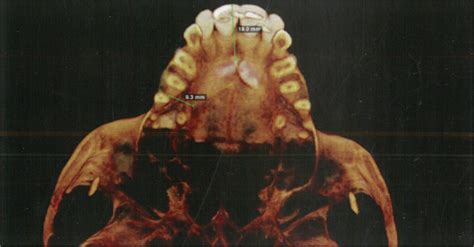 Evaluation Of A Correlation Between The Severity Of Root Resorption Of Adjacent Teeth And Level