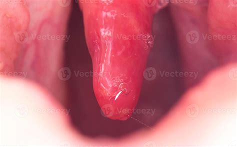 Uvulitis And Sore Throat In The Oral Cavity Due To Illness
