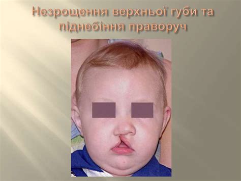 Ринолалія Online Presentation