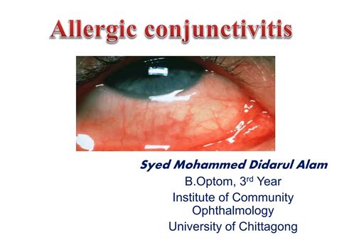 Allergic Conjunctivitis Pptx