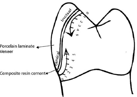 Criteria For Evaluation Of Microleakage Download Scientific Diagram
