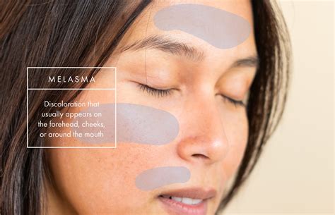 Melasma—what Causes It And How You Can Get Rid Of It At Home