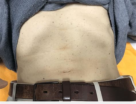 Multiple Petechiae On The Abdomen Download Scientific Diagram