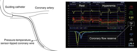 Invasive Assessment For Microcirculation Thoracic Key
