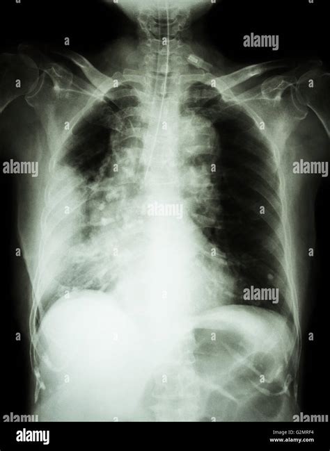 Lung Cancer Film Chest X Ray Show Right Lung Mass Wide Mediastinum