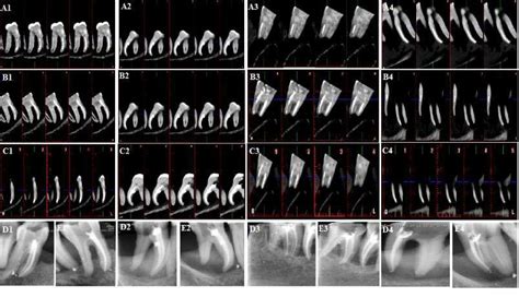 Images Taken For The Detection Of Four Different Endodontic