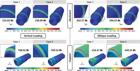 Stress Distribution On Abutment And Implant Download Scientific Diagram