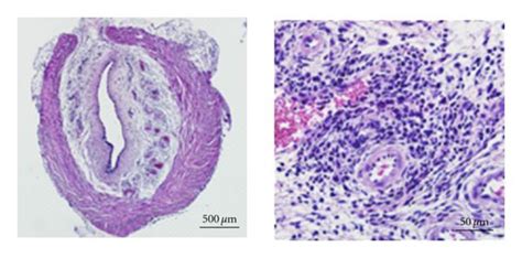 Intravesical Dmso Treatment Reduces Bladder Histopathology In Acute