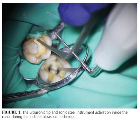 Mastering The Art Of Broken File Retrieval In Endodontics Decisions