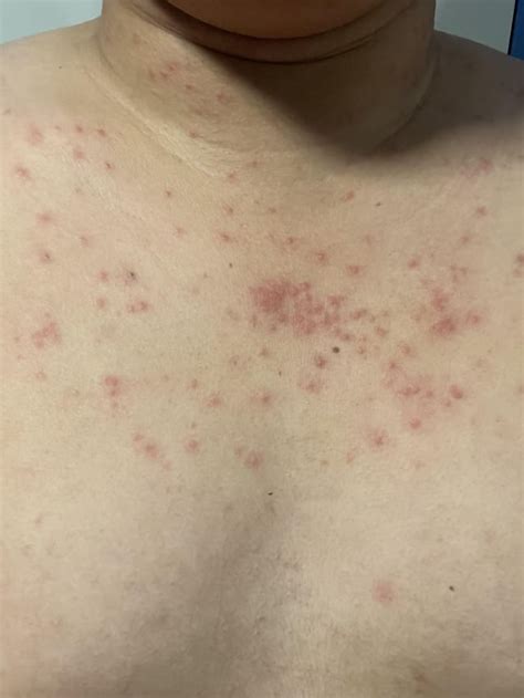 Is This Hiv Rash Had Unprotected Sex 2 Days Ago Very Worried As It