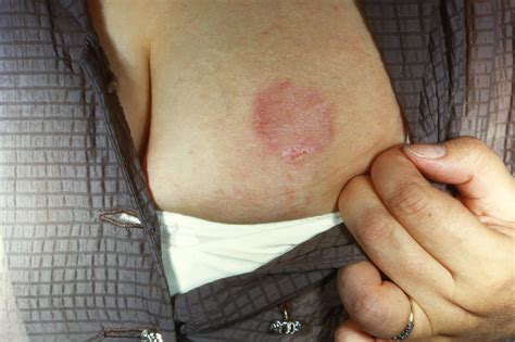 Clinical Pearl Tinea Corporis In Breastfeeding Mother