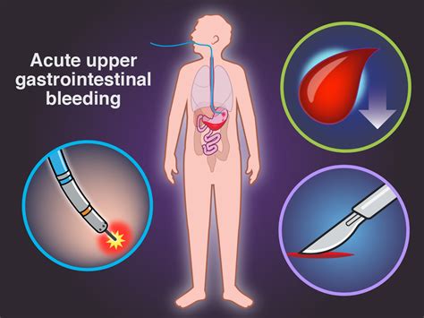 Upper Gi Bleed