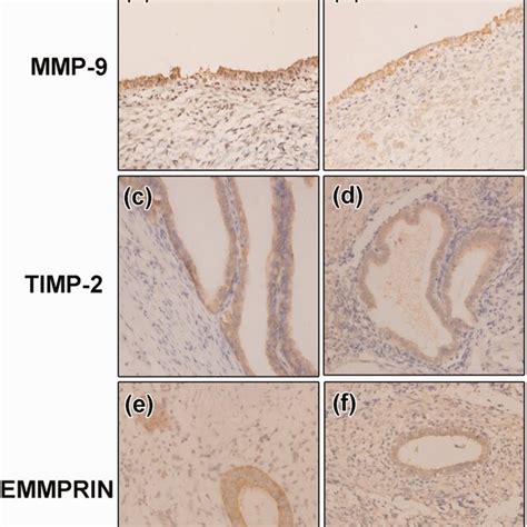 Immunostaining Of E Cadherin β Catenin And Upa Expression In