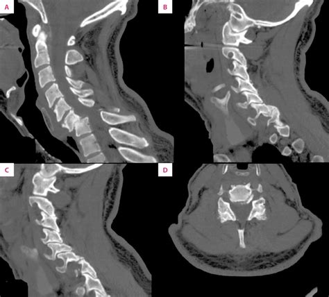 Ct Imaging A Sagittal View Of Bilateral Facet Dislocation With Bony