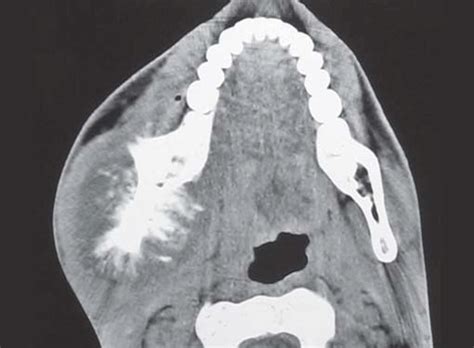 Axial Ct Scan Shows Osteosclerosis And Erosion Of The Condyle Extending