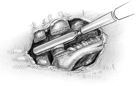 Lung Segmentectomy For Patients With Peripheral T1 Lesions Operative Techniques In Thoracic