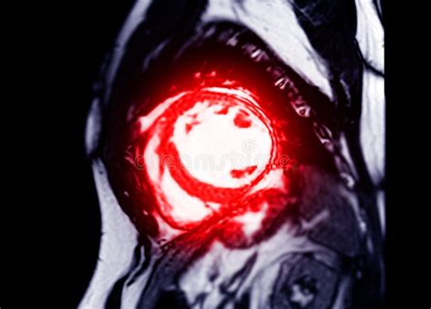 mri heart or cardiac mri in short axis view showing cross sections of