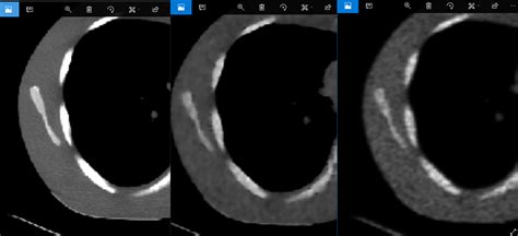 Denosing Lung Ct Scans Using Neural Networks With Interactive Code