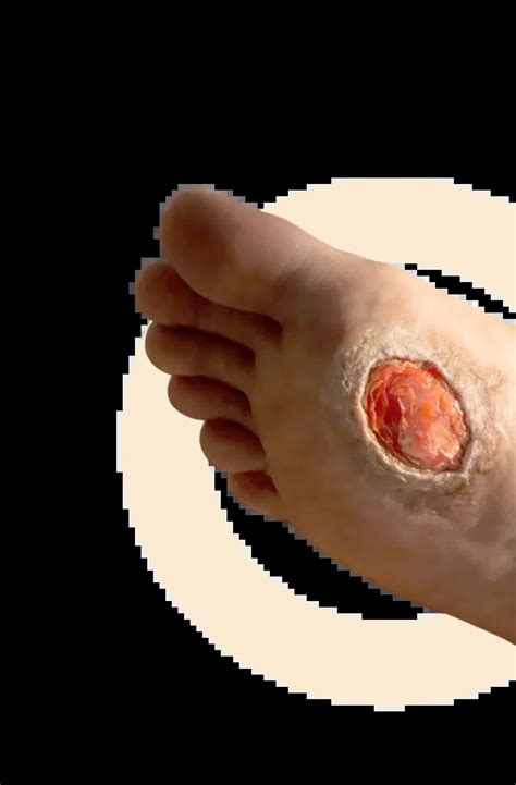 Diabetic Foot Ulcer Symptoms Stages Treatment And Ayurvedic Care