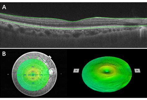 Video Determining Gender Based Differences In Retinal And Choroidal Thickness In Underweight