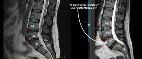 “lumbarised S1” The Transitional Potentially Mobile Lumbosacral Segment And Its Excellent