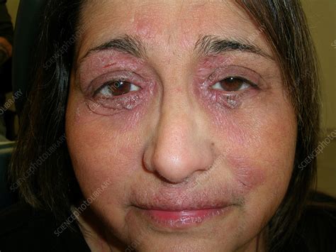 Atopic Dermatitis Stock Image C056 5334 Science Photo Library