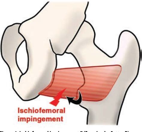 Figure 1 From Ischiofemoral Impingement Syndrome Semantic Scholar