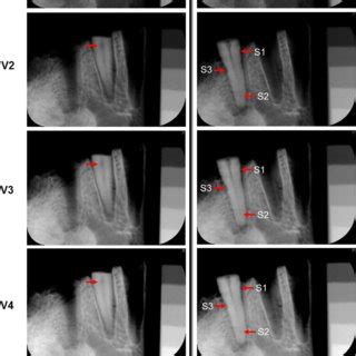 Digital Radiographic Images Showing Examples Of Simulated IRR And ERR Download Scientific