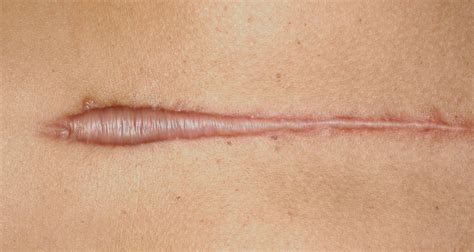 Radiotherapy In Keloid Care Evidence Techniques And Future