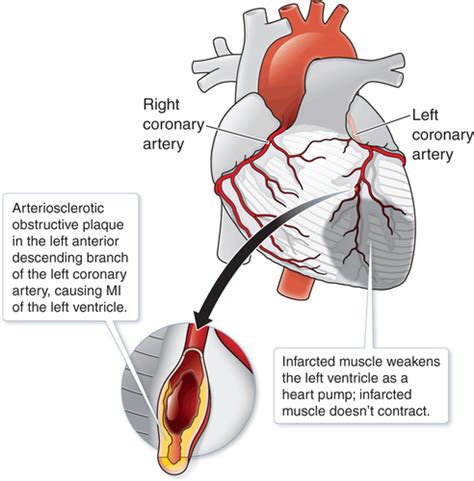 Pathophysiology Chapter 17 Heart Failure Flashcards Quizlet Pathophysiology Chapter 17 Heart Failure Flashcards Quizlet