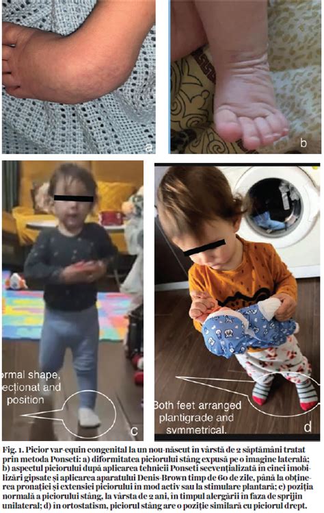 Un Nou Procedeu Eclectic în Tratamentul Chirurgical Al Piciorului Var Equin Recidivat Rezidual
