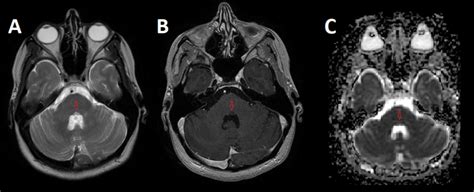 A Axial Magnetic Resonance Imaging T2 Sequence Demonstrates A Download Scientific Diagram