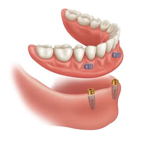 Locator Denture In Toronto Atlas Dental