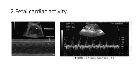 Fetal Biometry Parameters Lk Pptx