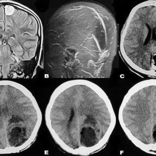 A Contrast Enhanced Mri Brain Showing Left Posterior Parasagittal